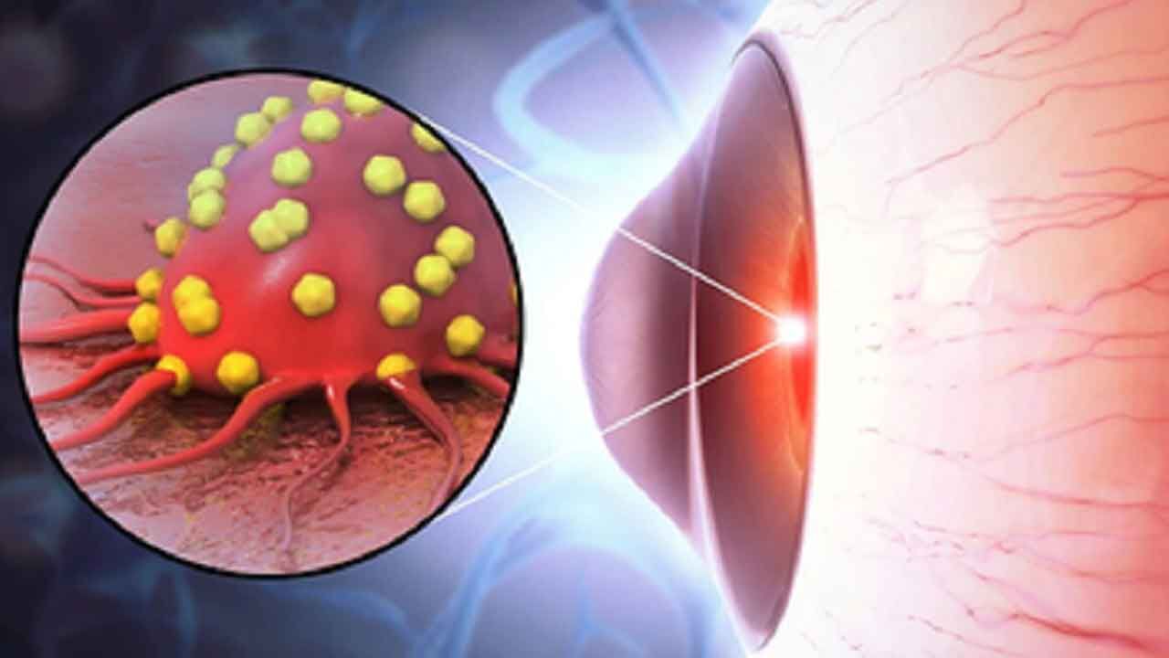 New Drug Delivery System Effective Against Rare Eye Cancer